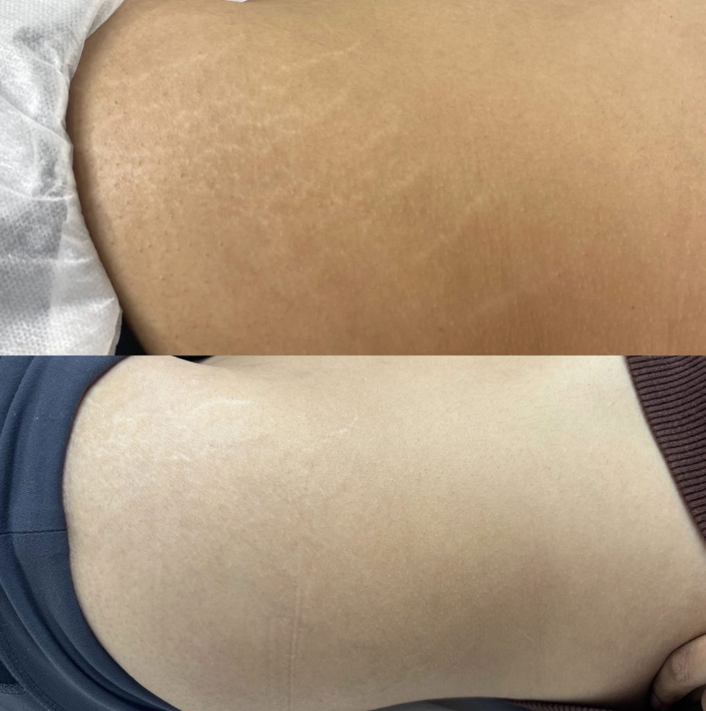 Stretch Mark Camouflage: Paramedical Tattooing - Scar Camo